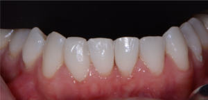 Before & After Cosmetic Reshaping of Teeth Photos Lancaster PA ...
